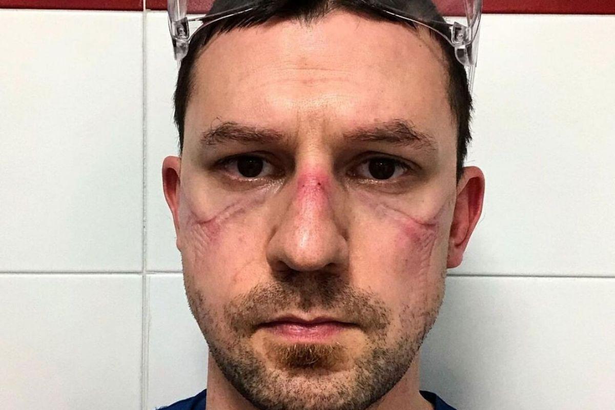 Selfie de médico com o rosto machucado após trabalhar 12 horas viraliza ...